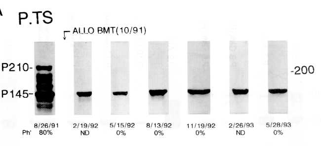 Blood Test for Ph Chromosome Leukemias
